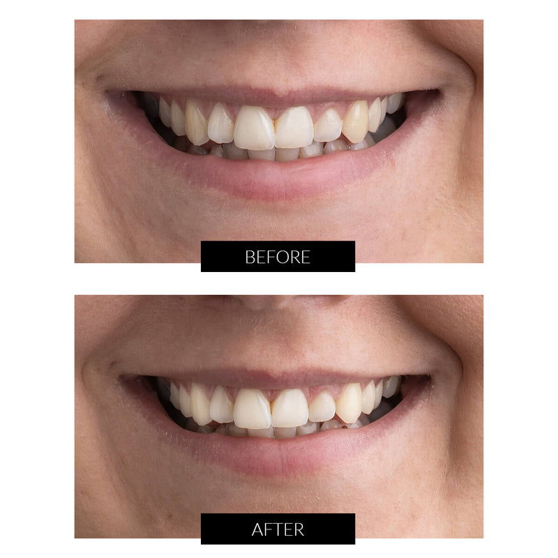 CurrentBody Skin Teeth Whitening Kit | CurrentBody Australia